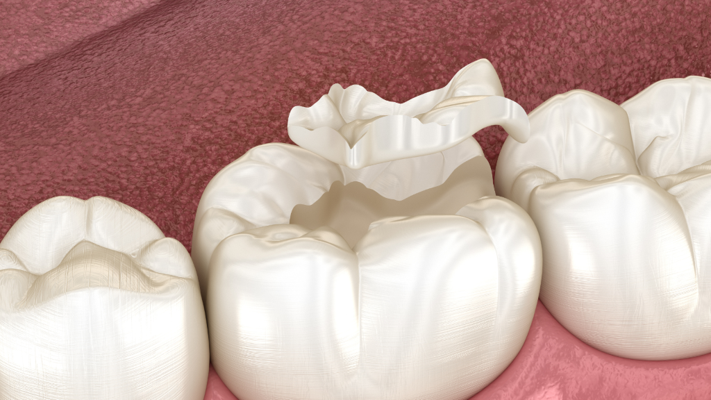 Dental Inlays and Onlays | Vancouver - ByDesign Implant Dentistry