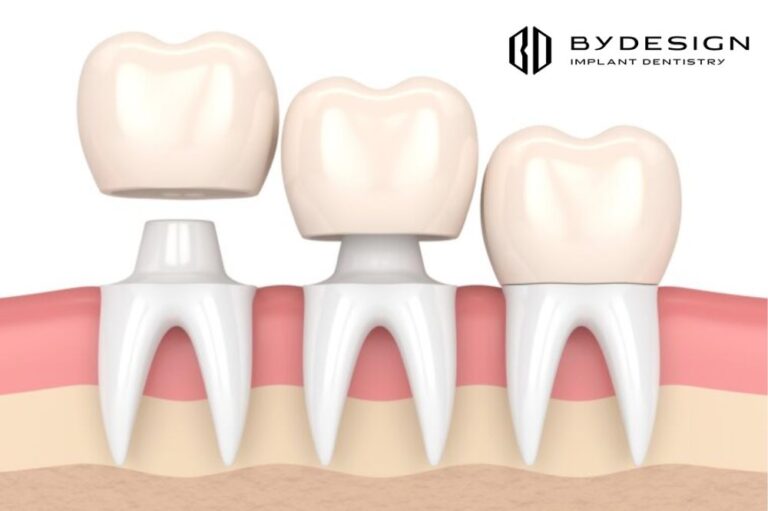 Step-by-Step Guide to Getting a Dental Crown - ByDesign Implant Dentistry